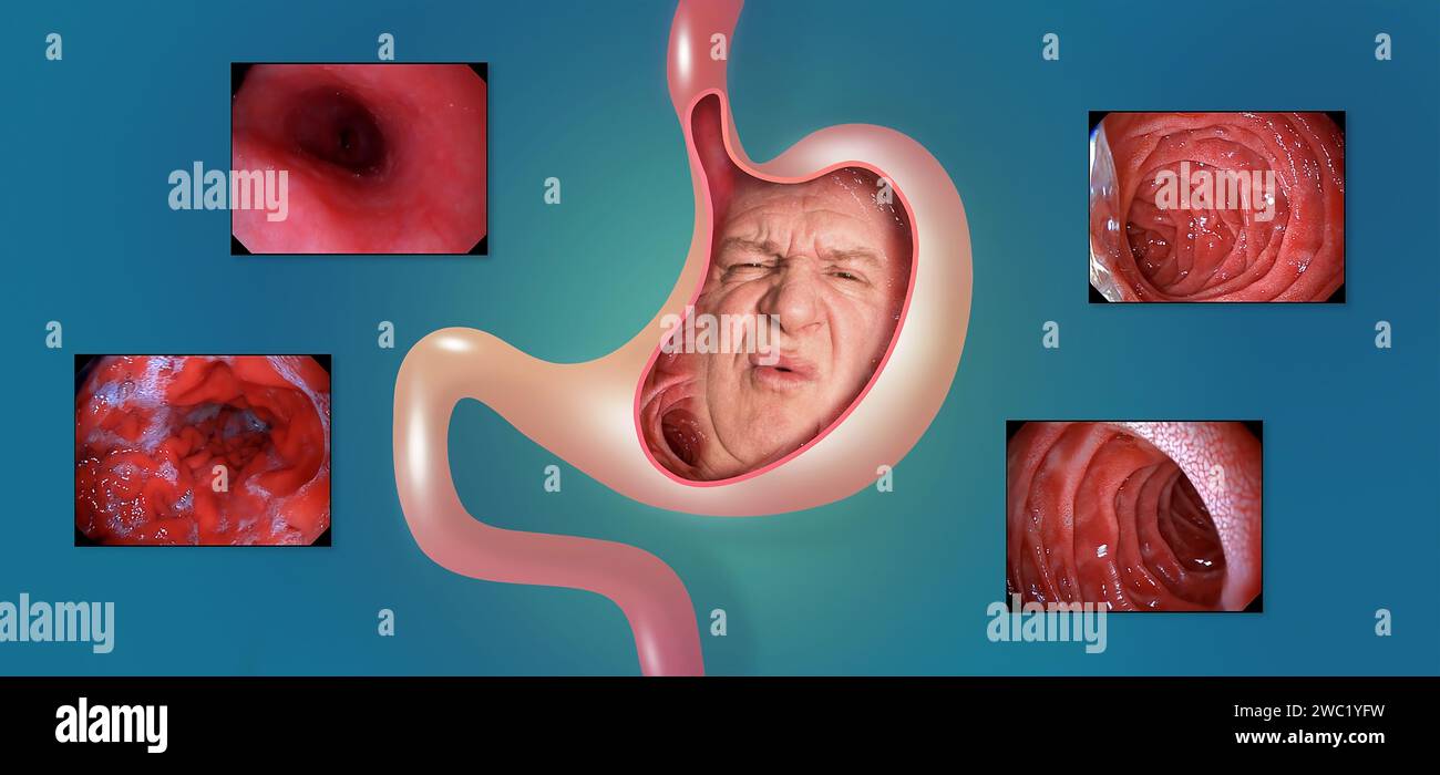 Stomach pain and human face. Digestive endoscopy or gastroscopy ...
