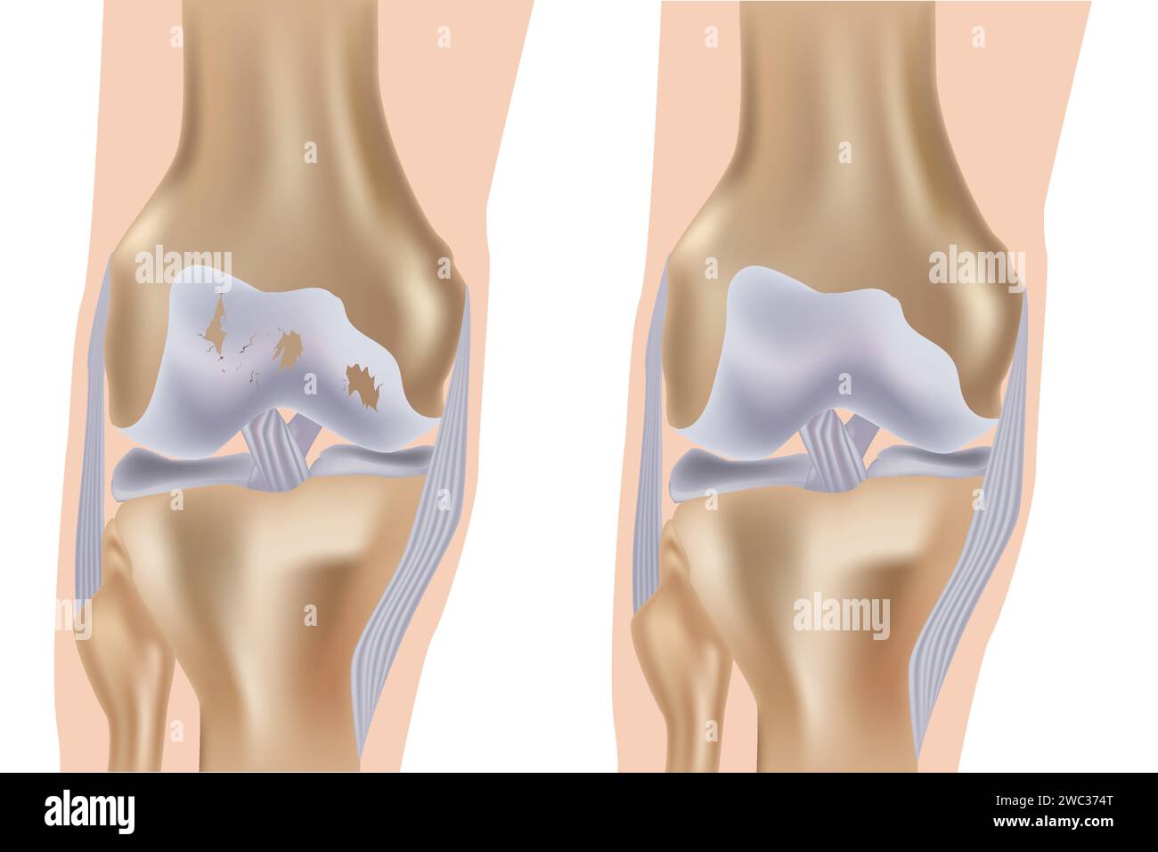 Medical vector illustration with damaged knee structure and healthy knee comparison. Knee ...