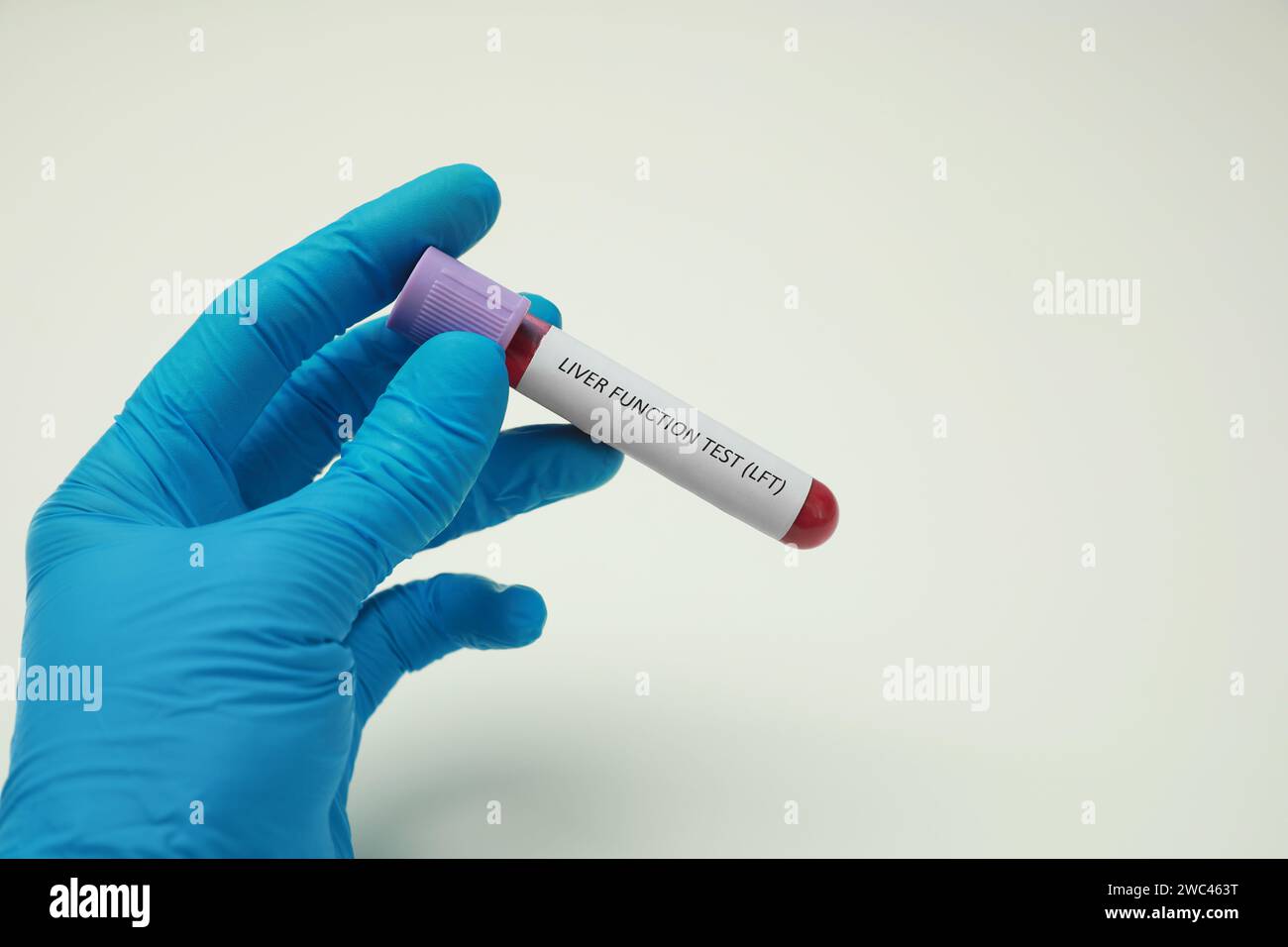 Laboratory worker holding tube with blood sample and label Liver ...