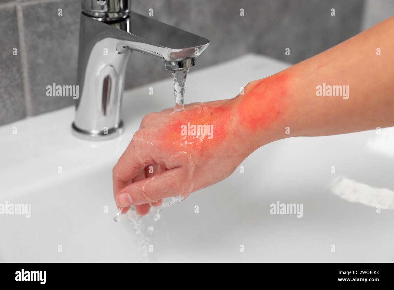 Burn skin cold water hi-res stock photography and images - Alamy