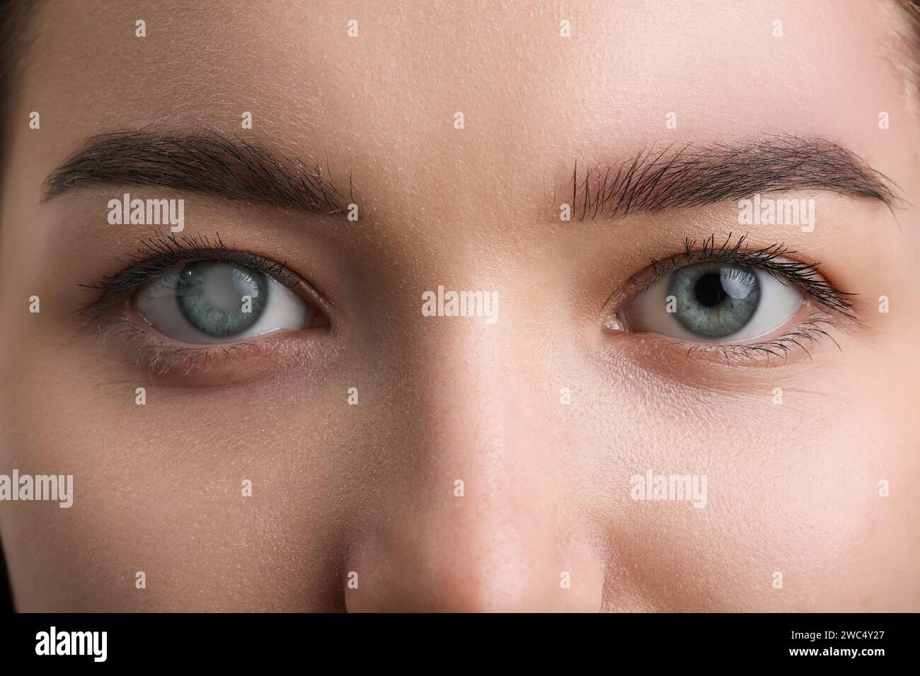 Glaucoma symptoms hi-res stock photography and images - Alamy
