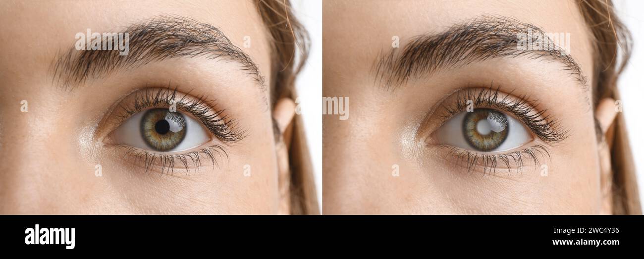 Closeup view of woman before and after glaucoma treatment on white ...