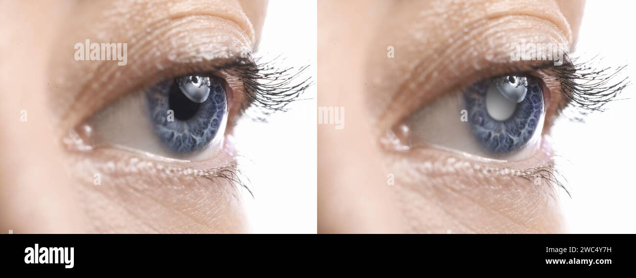 Closeup view of woman before and after glaucoma treatment on white ...