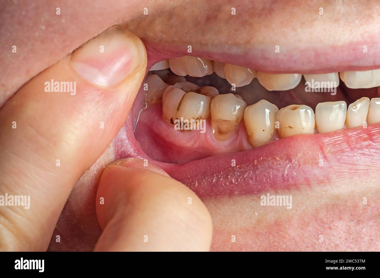 Teeth with plaque close-up. The filling fell off the tooth Stock Photo ...