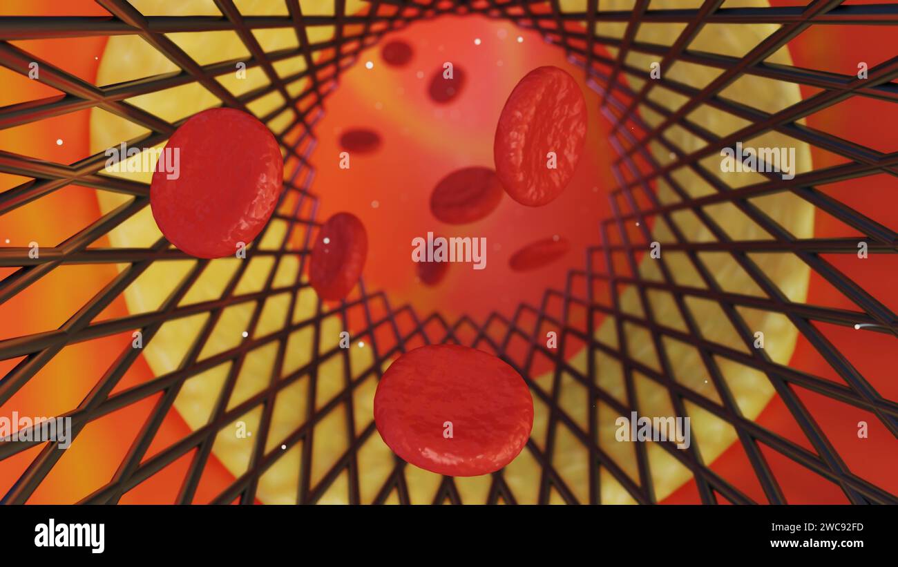 Aided by the metallic scaffolding of a stent, tiny red blood cells ...