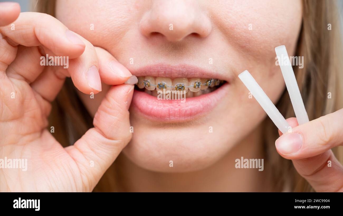Close-up portrait of a woman with braces using special orthodontic wax ...