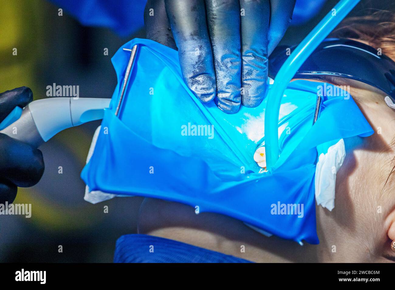 dentist treating a sick tooth to a patient together with an assistant ...