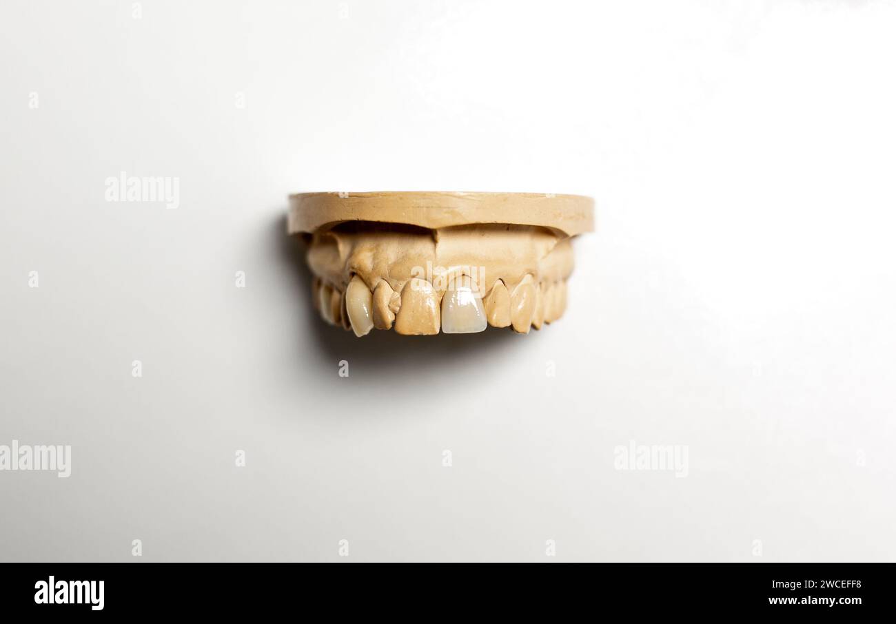 Dental crowns. Close-up ceramic tooth crown Stock Photo - Alamy