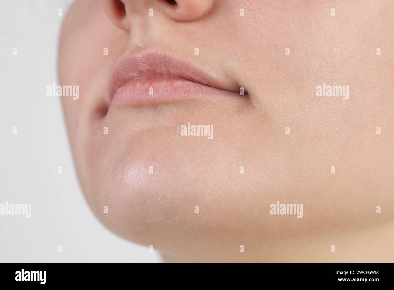 Woman with dry skin on white background, closeup view Stock Photo - Alamy
