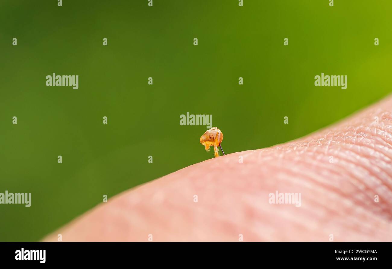 bee sting close-up stuck into human skin after being bitten by a ...