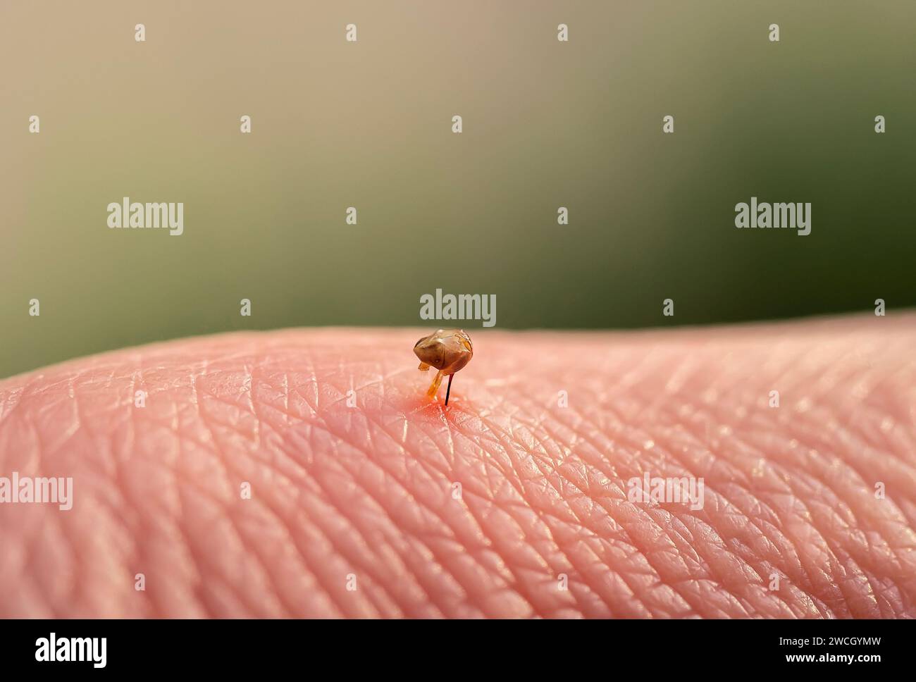 bee sting close-up stuck into human skin after being bitten by a ...