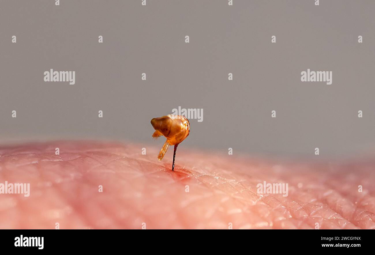 bee sting close-up stuck into human skin after being bitten by a ...