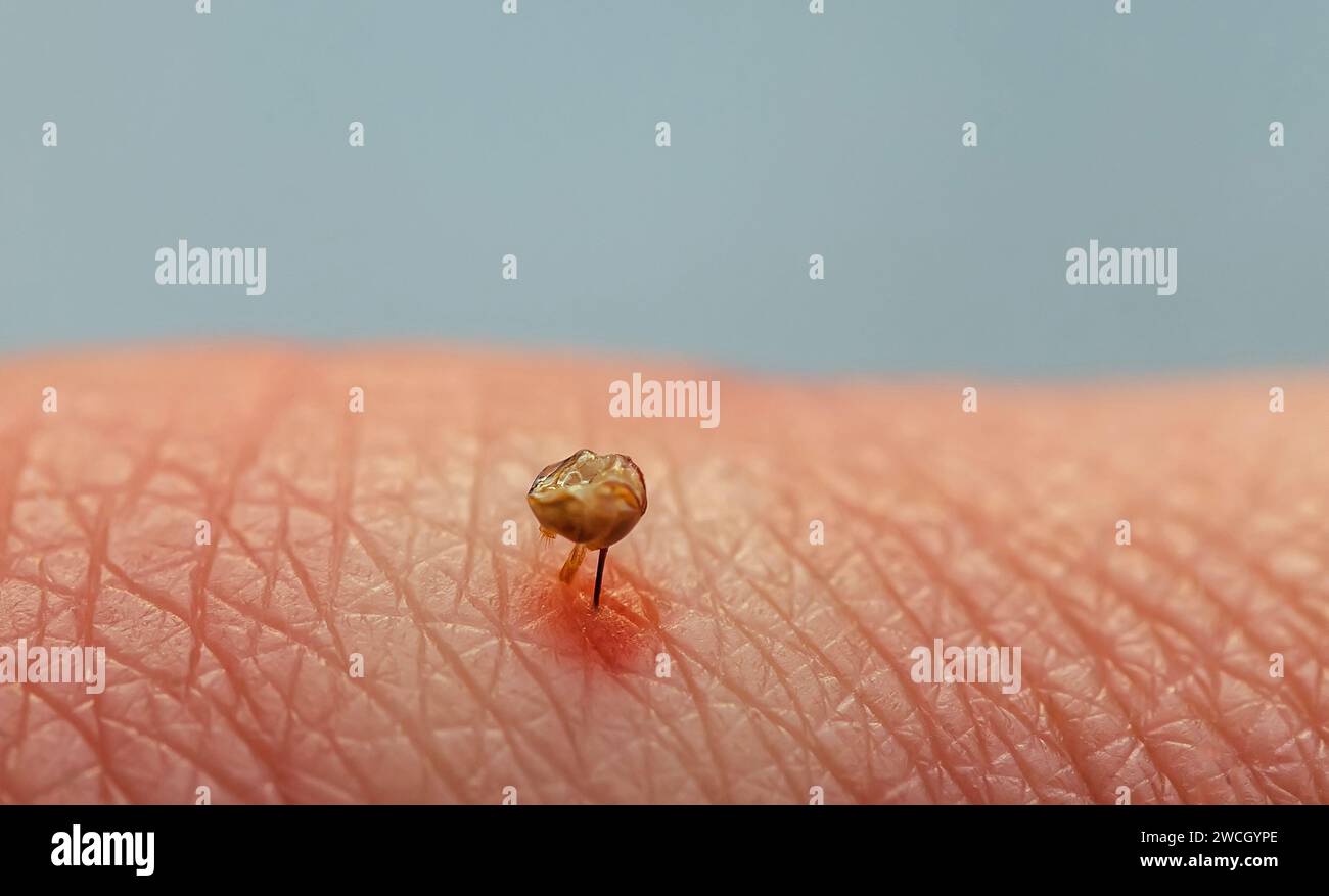 bee sting close-up stuck into human skin after being bitten by a ...