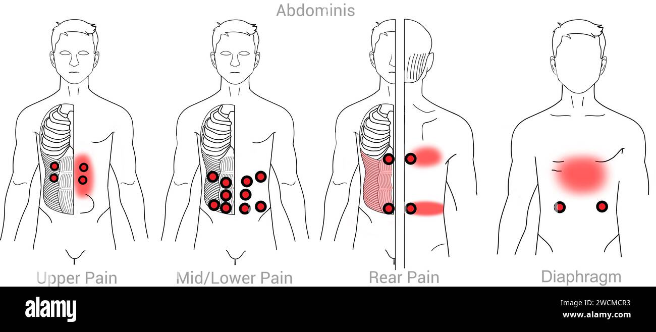 Abdominis: Myofascial trigger points and associated pain locations ...