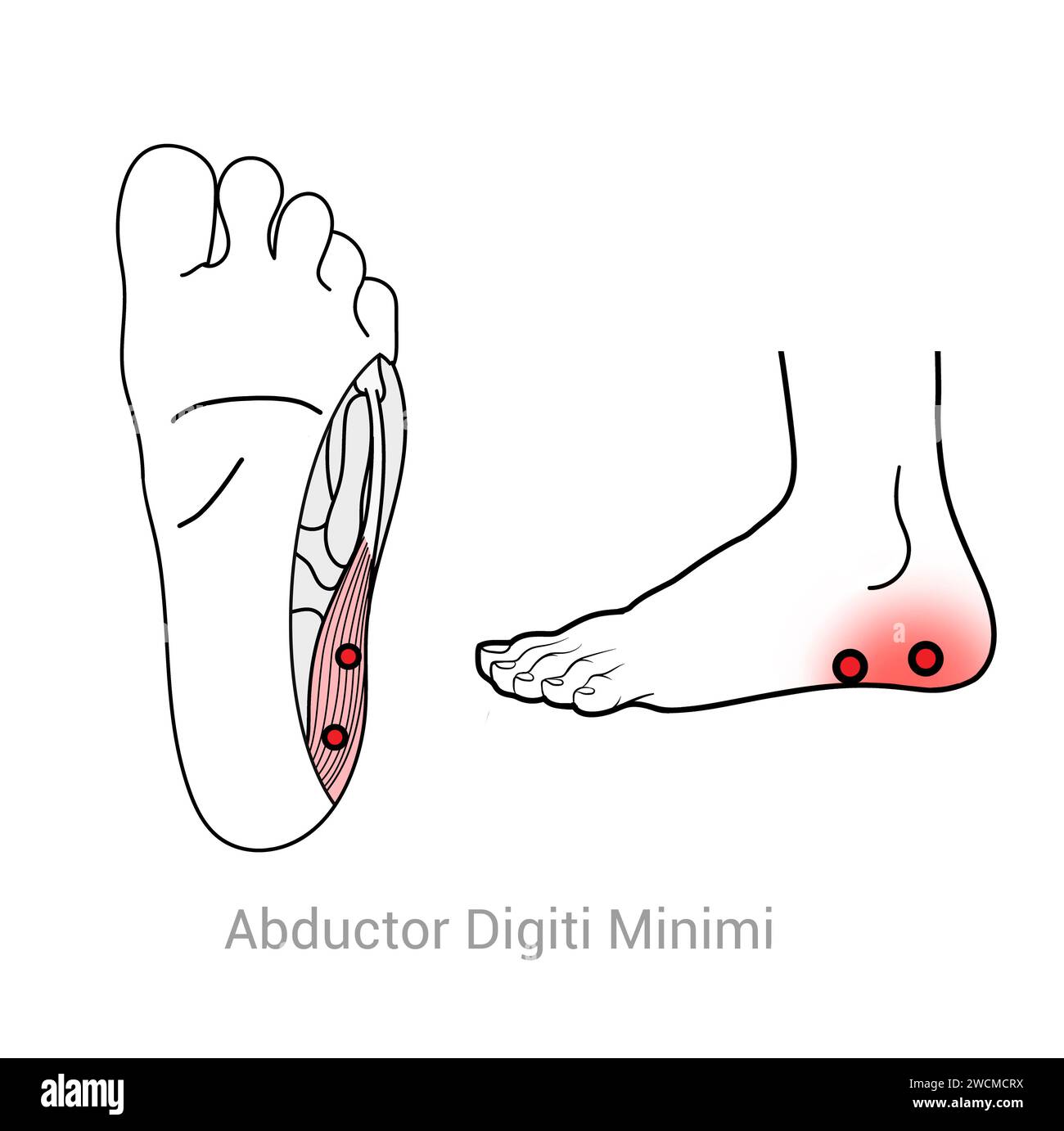 Abductor Digiti Minimi: Myofascial trigger points and associated pain ...