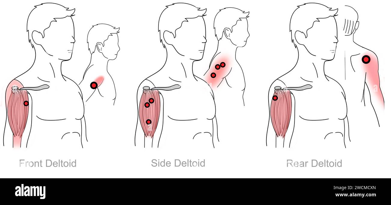 Deltoids: Myofascial trigger points and associated pain locations Stock ...