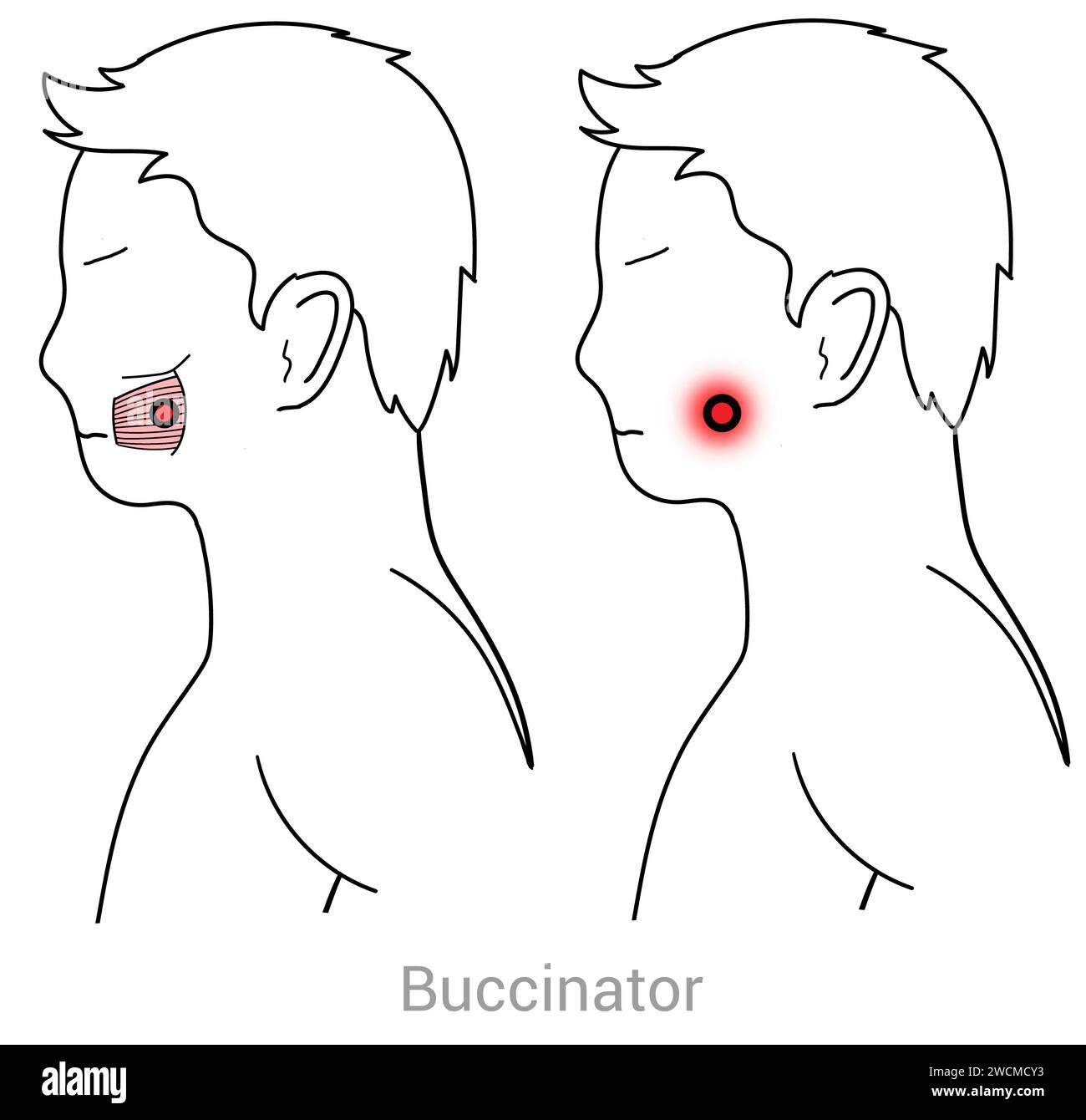 Buccinator: Myofascial trigger points and associated pain locations ...