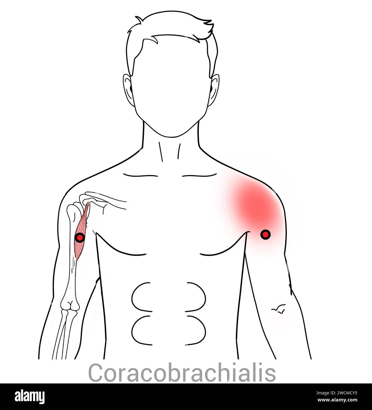 Coracobrachialis: Myofascial trigger points and associated pain ...
