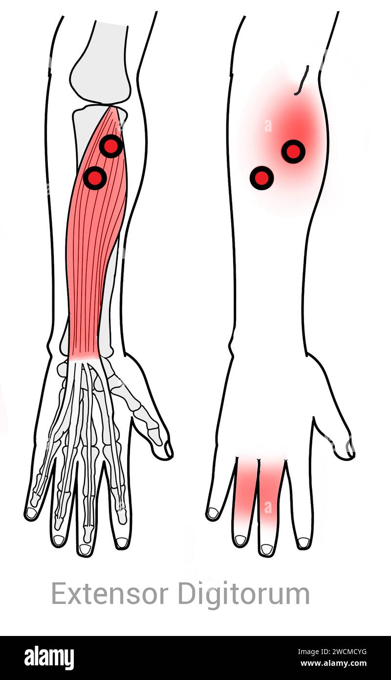 Extensor Digitorum: Myofascial trigger points and associated pain ...