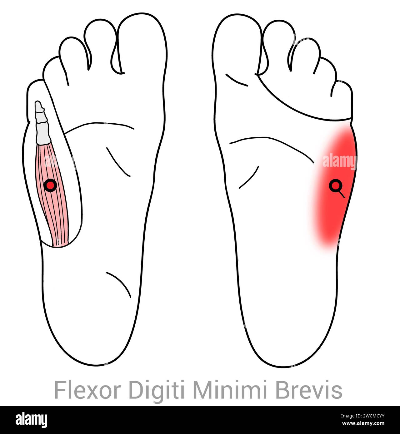 Flexor Digiti Minimi Brevis: Myofascial trigger points and associated ...