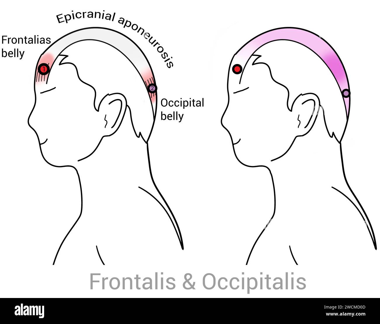 Frontalis and Occipitalis: Myofascial trigger points and associated ...