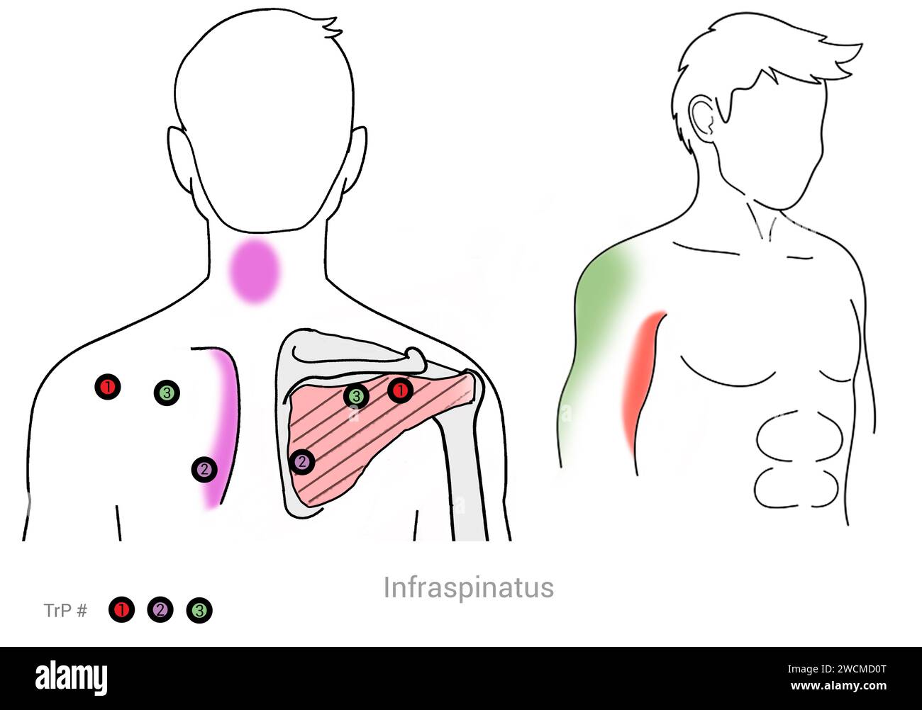 Infraspinatus: Myofascial trigger points and associated pain locations ...