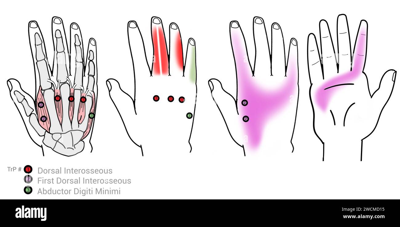 Interosseous muscles: Myofascial trigger points and associated pain ...