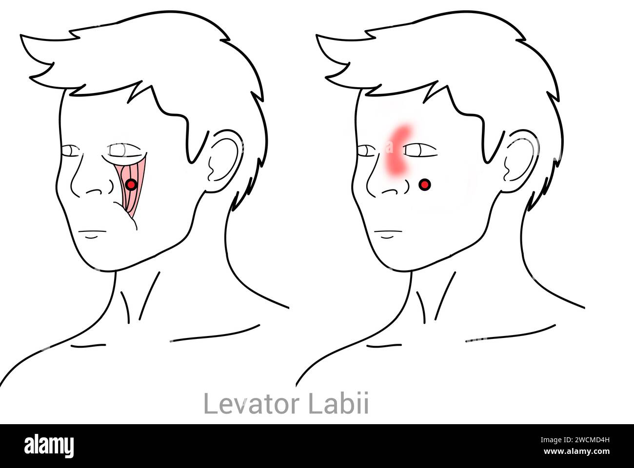 Levator Labii: Myofascial trigger points and associated pain locations ...