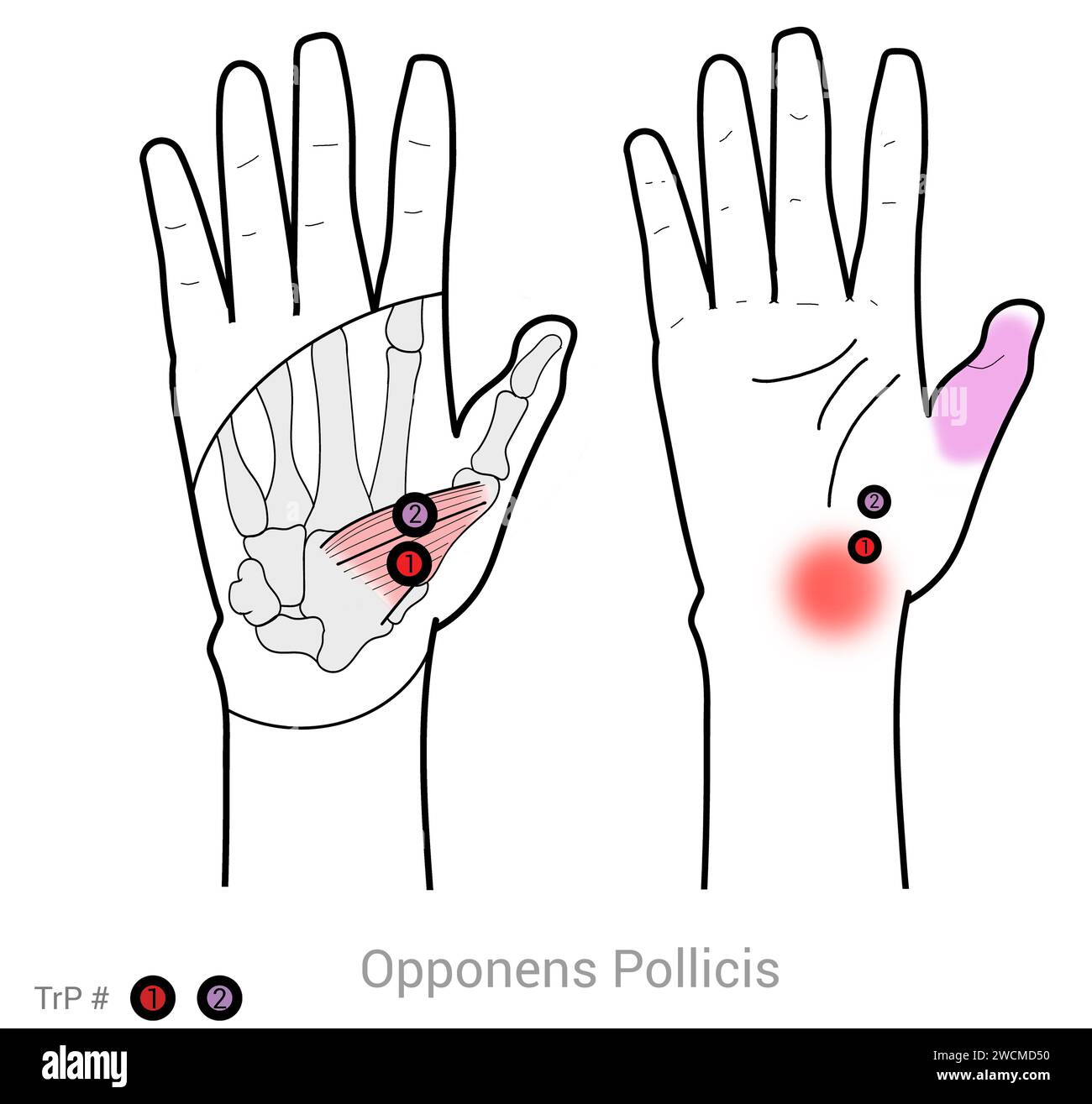 Opponens Pollicis: Myofascial trigger points and associated pain ...