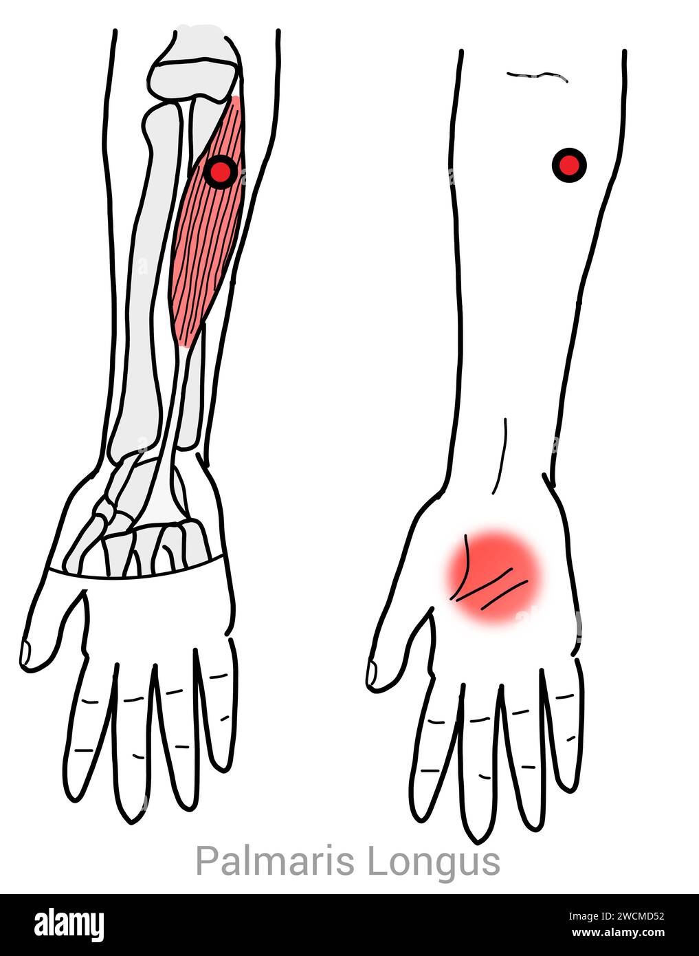 Palmaris Longus