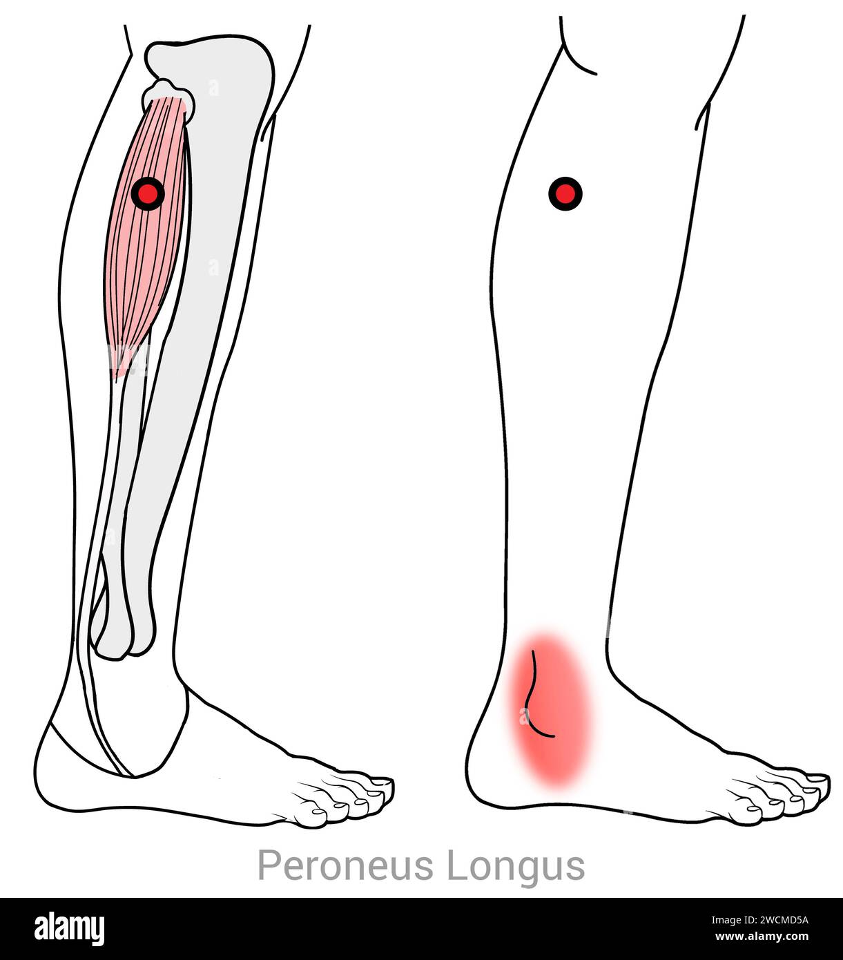 Peroneus Longus: Myofascial trigger points and associated pain ...