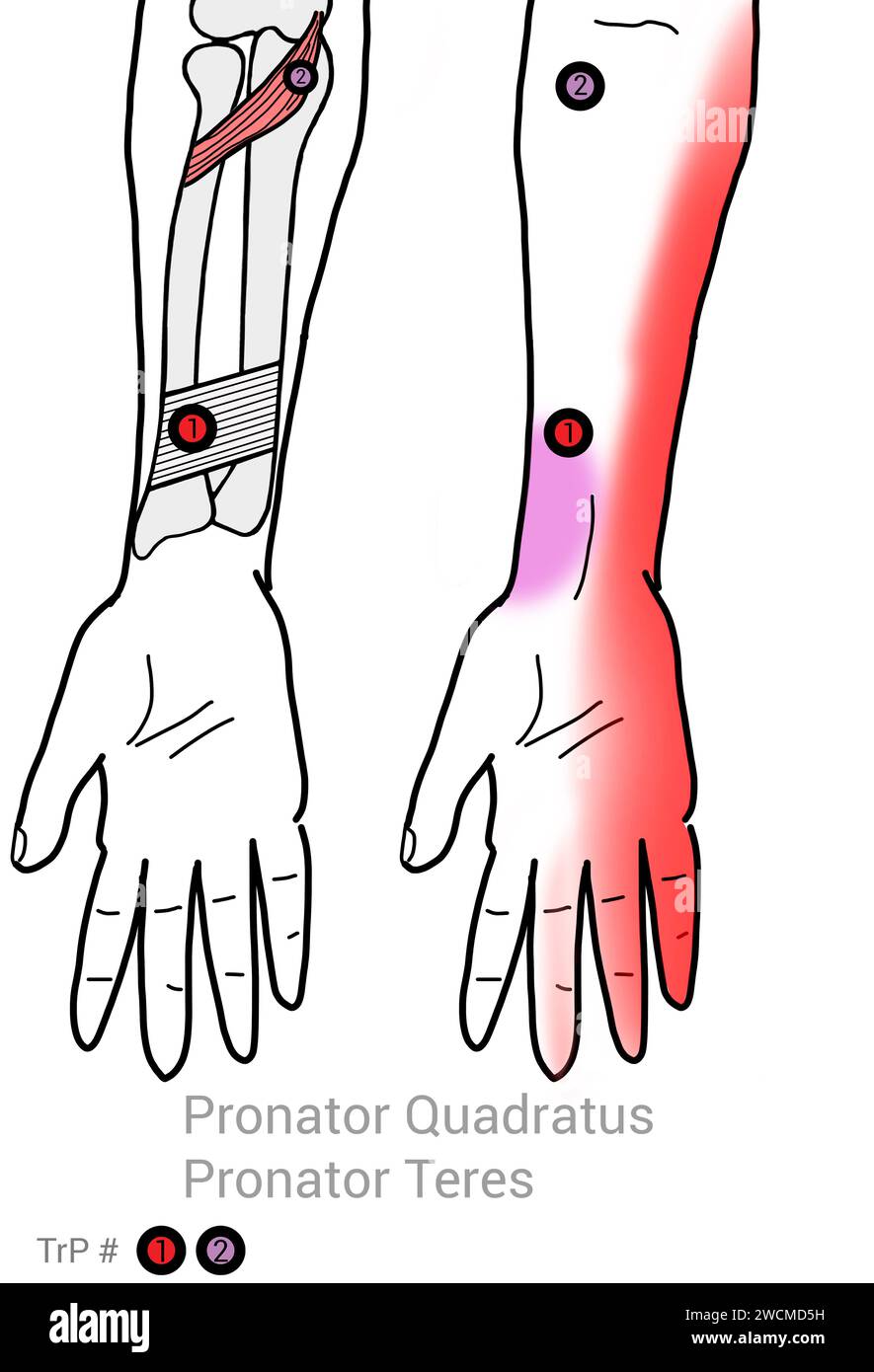 Pronator Quadratus and Pronator Teres: Myofascial trigger points and ...