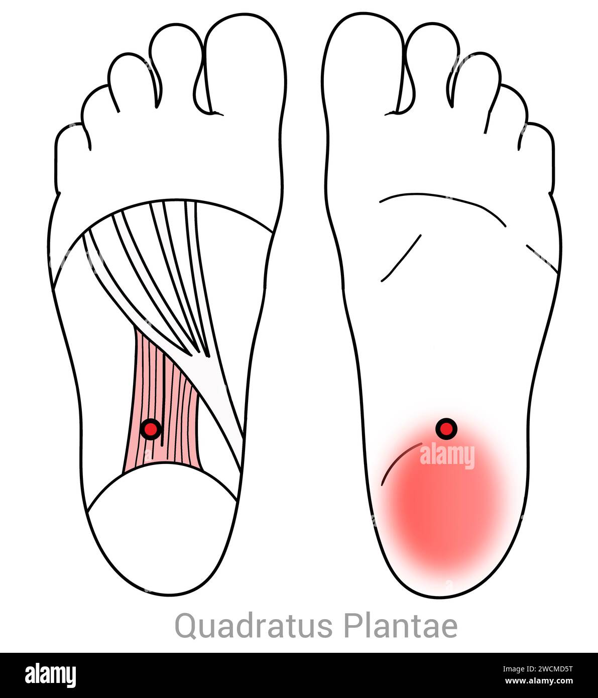 Quadratus Plantae Mri