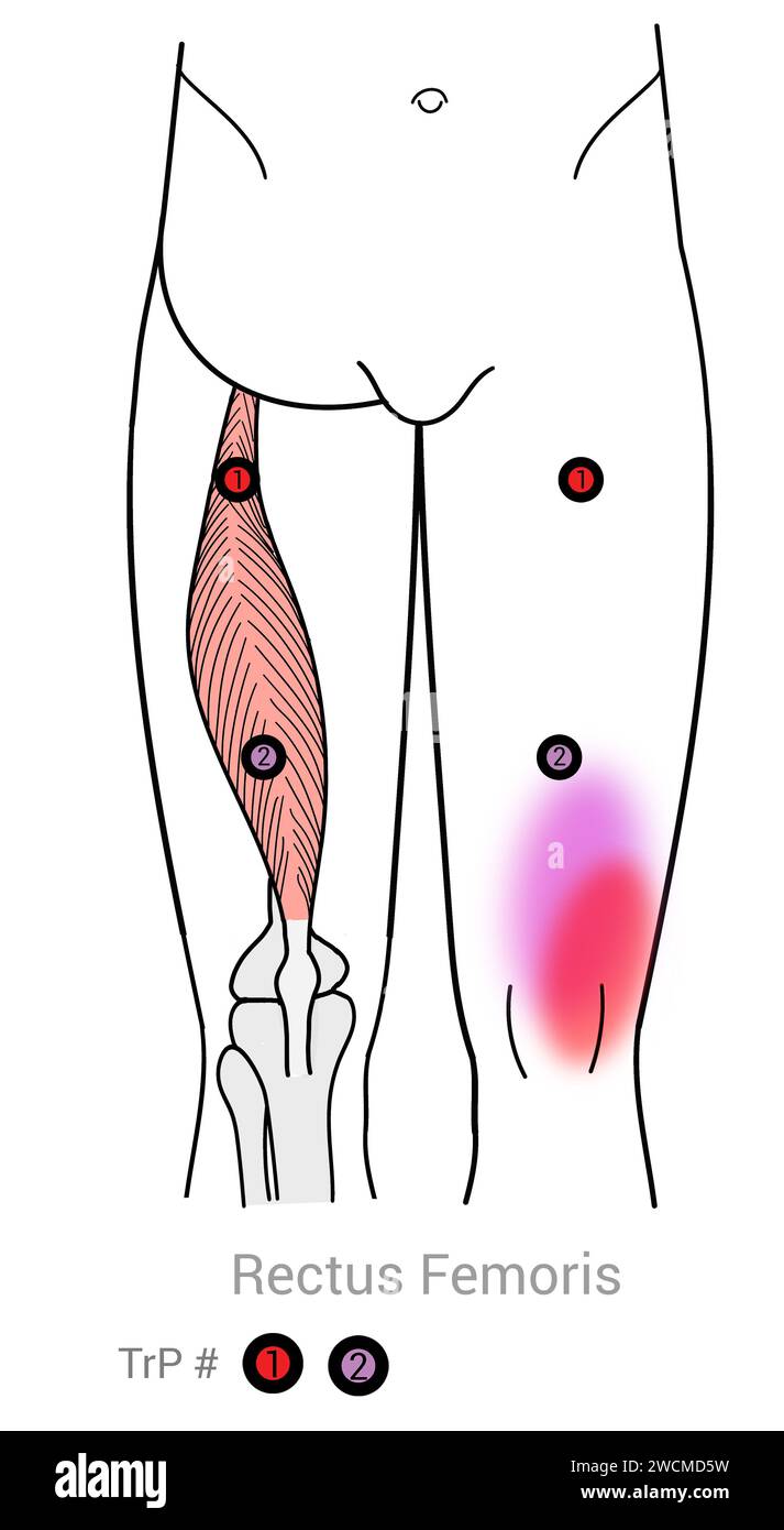 Rectus Femoris: Myofascial trigger points and associated pain locations ... Rectus Femoris: Myofascial trigger points and associated pain locations ...