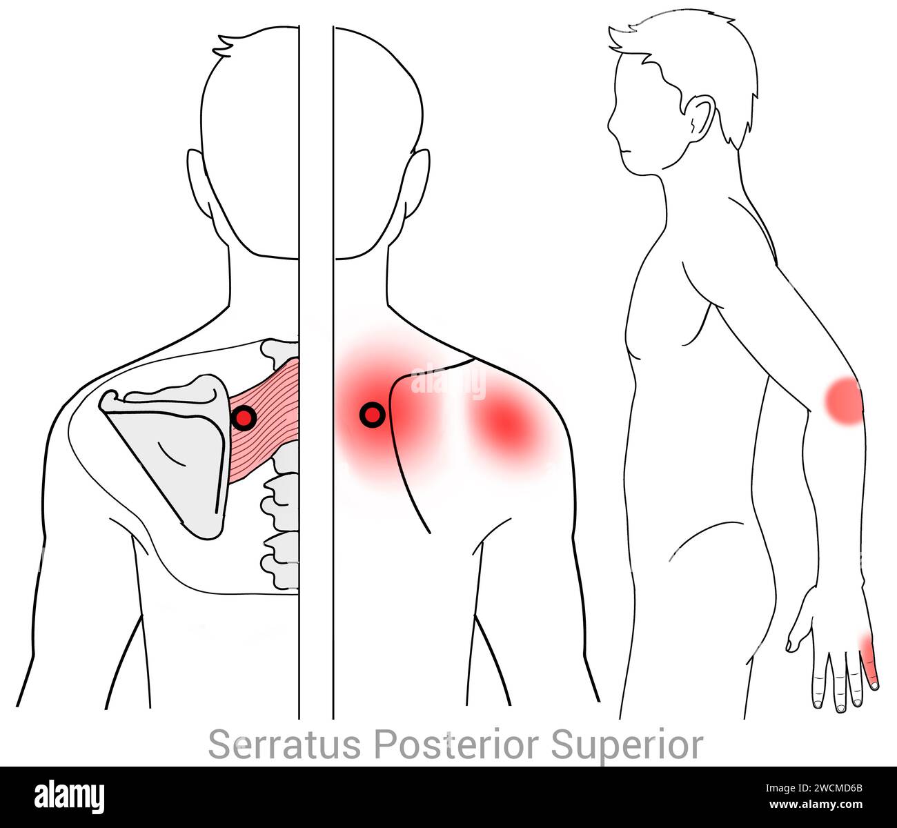 Serratus Posterior Superior Trigger Point Ep 328 The Serratus
