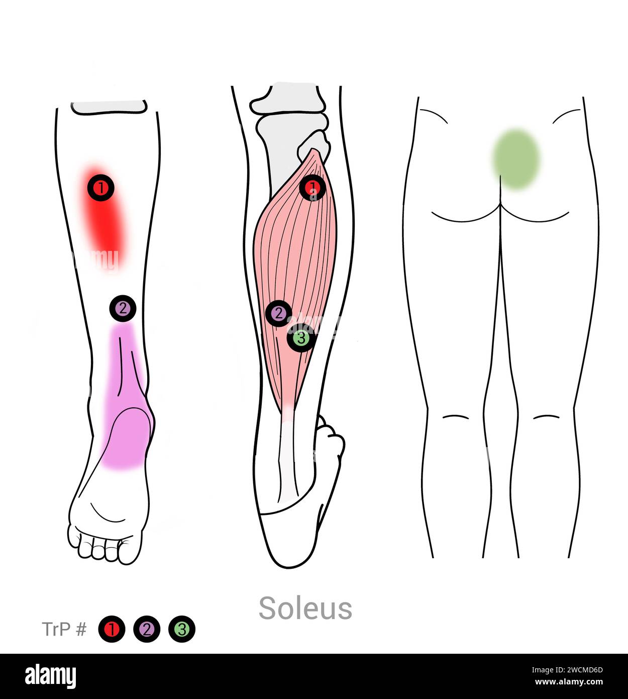Soleus: Myofascial trigger points and associated pain locations Stock ...