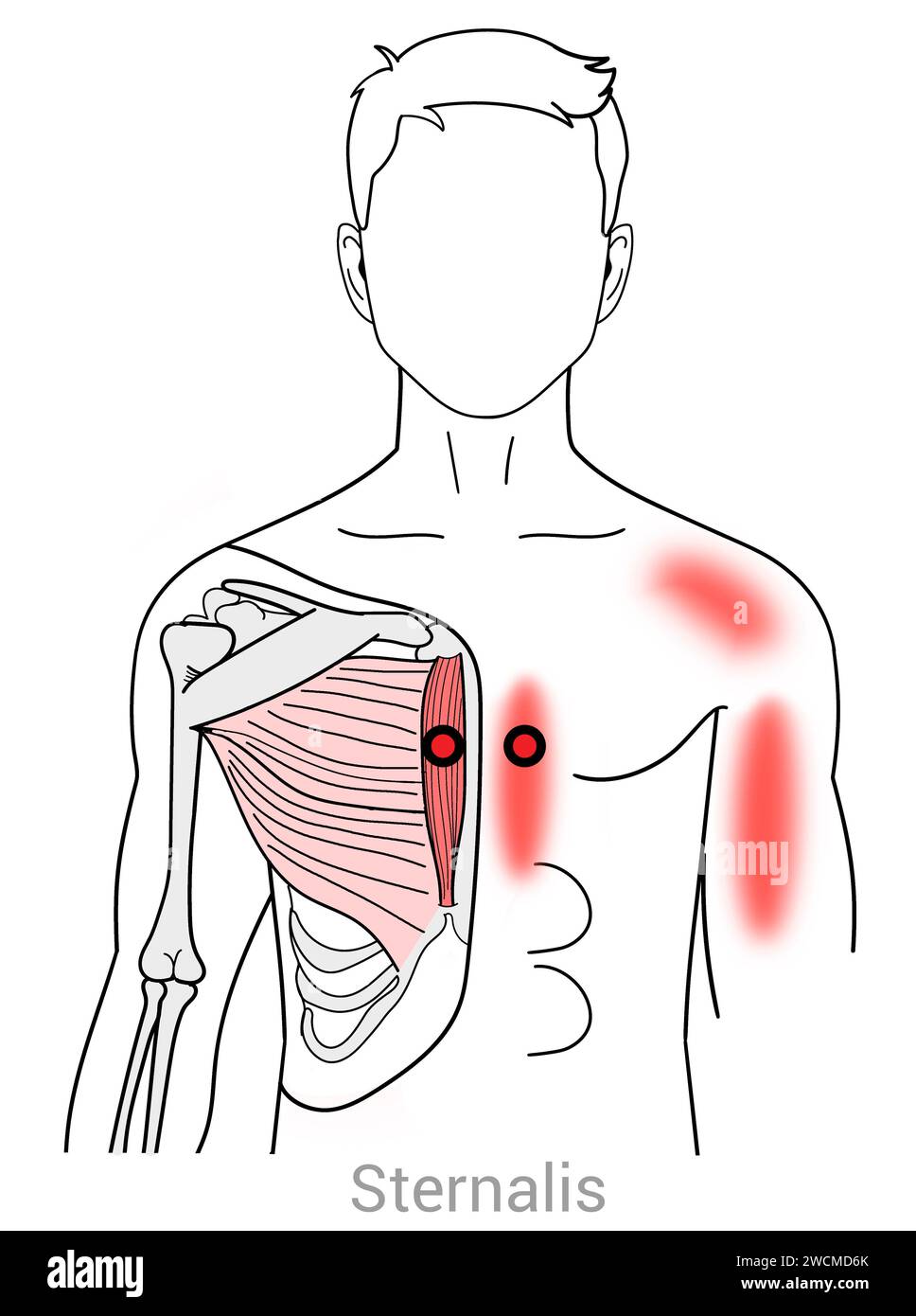 Sternalis: Myofascial trigger points and associated pain locations ...