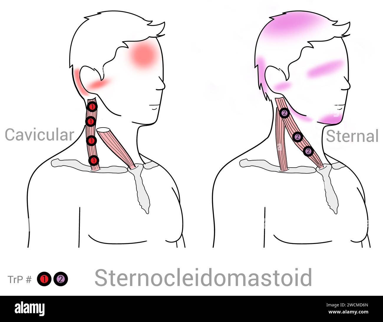 Sternocleidomastoid Trigger Points The Sternocleidomastoid Muscle