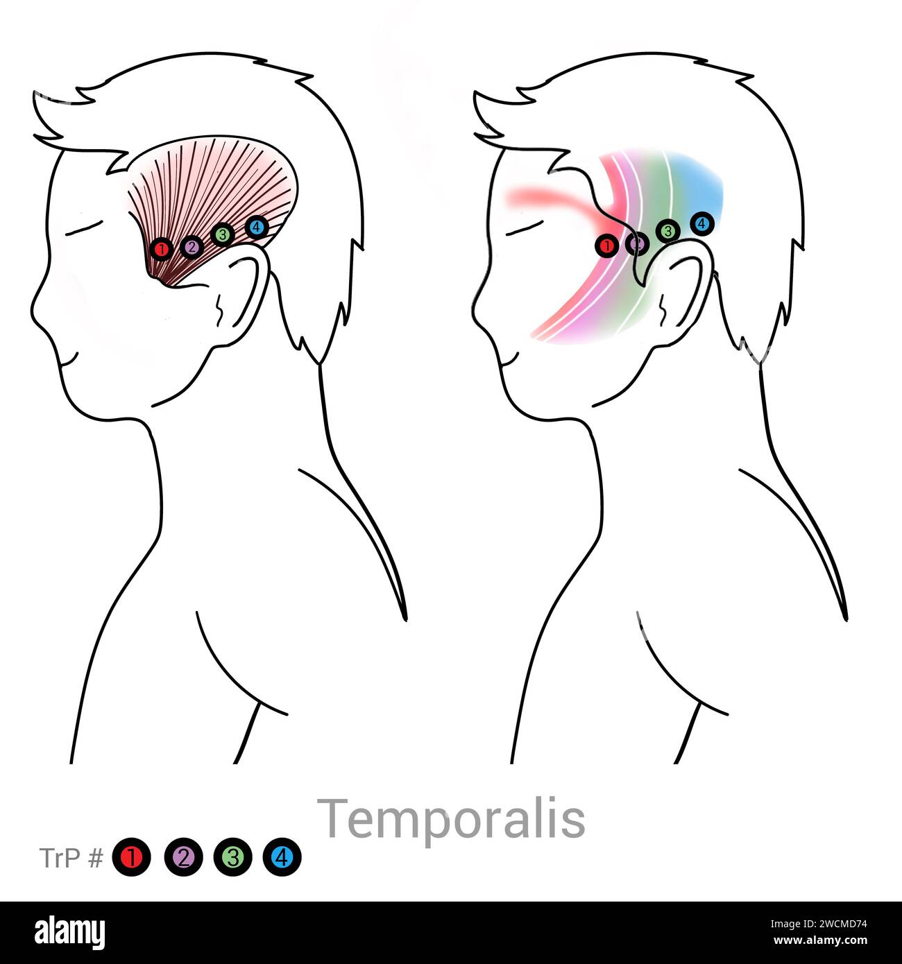 Temporalis: Myofascial trigger points and associated pain locations ...