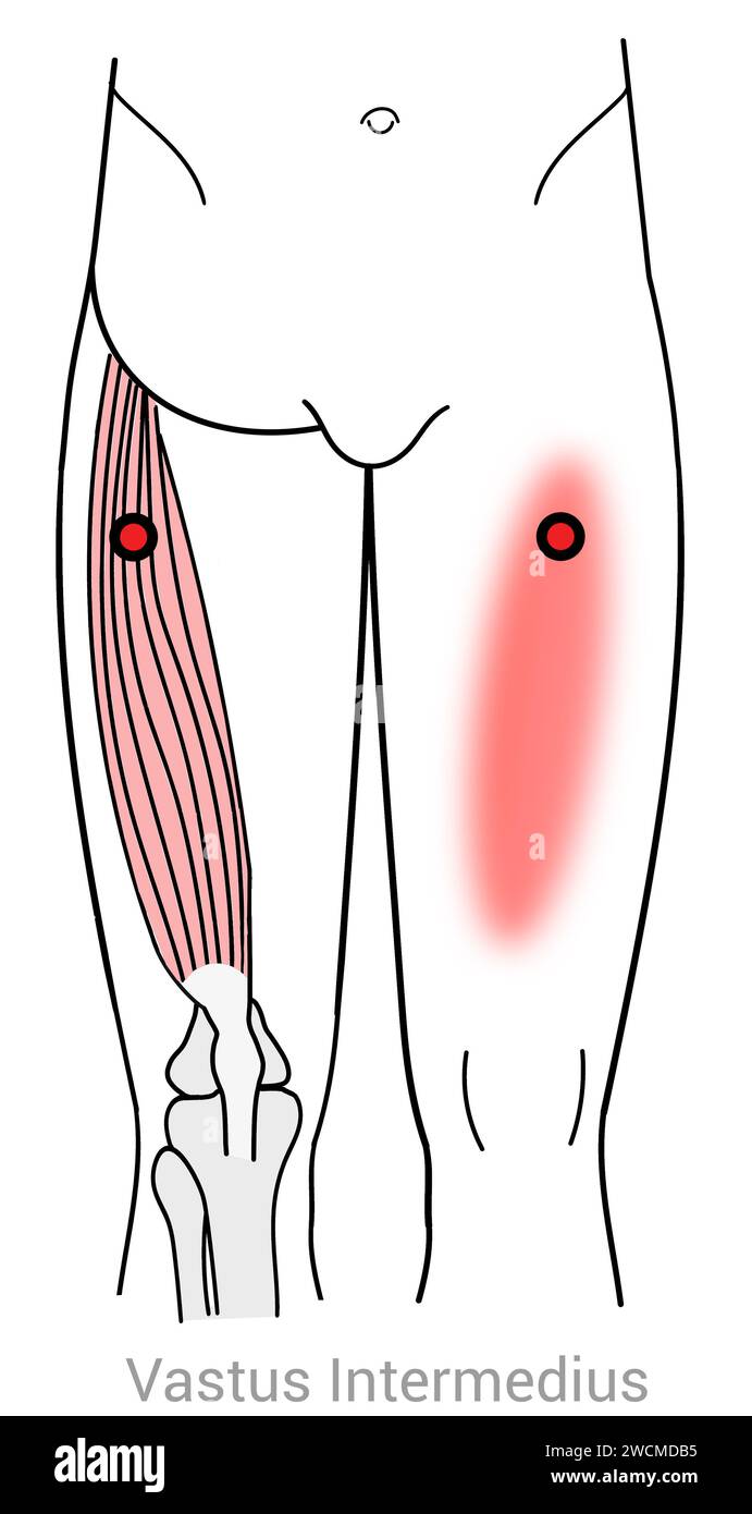 Femoral Triangle Trigger Points