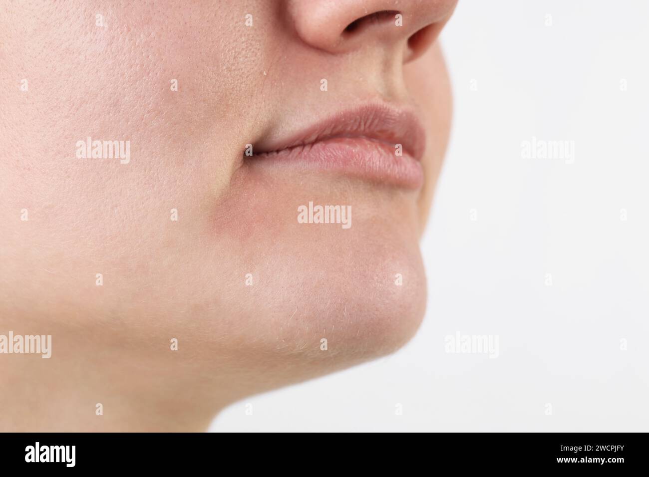 Woman with dry skin on white background, closeup view Stock Photo - Alamy