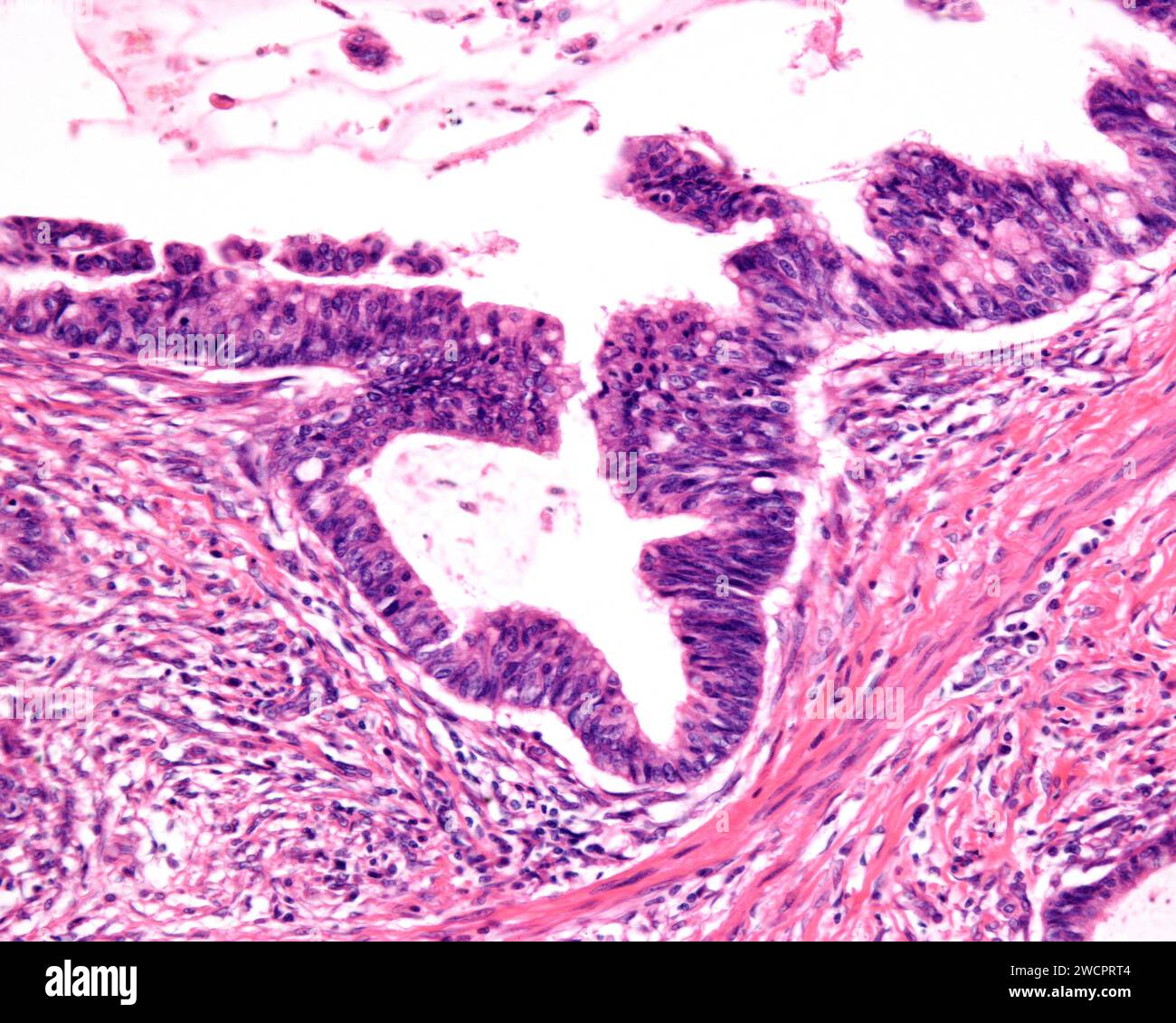 Adenocarcinoma of the colon, light micrograph Stock Photo - Alamy