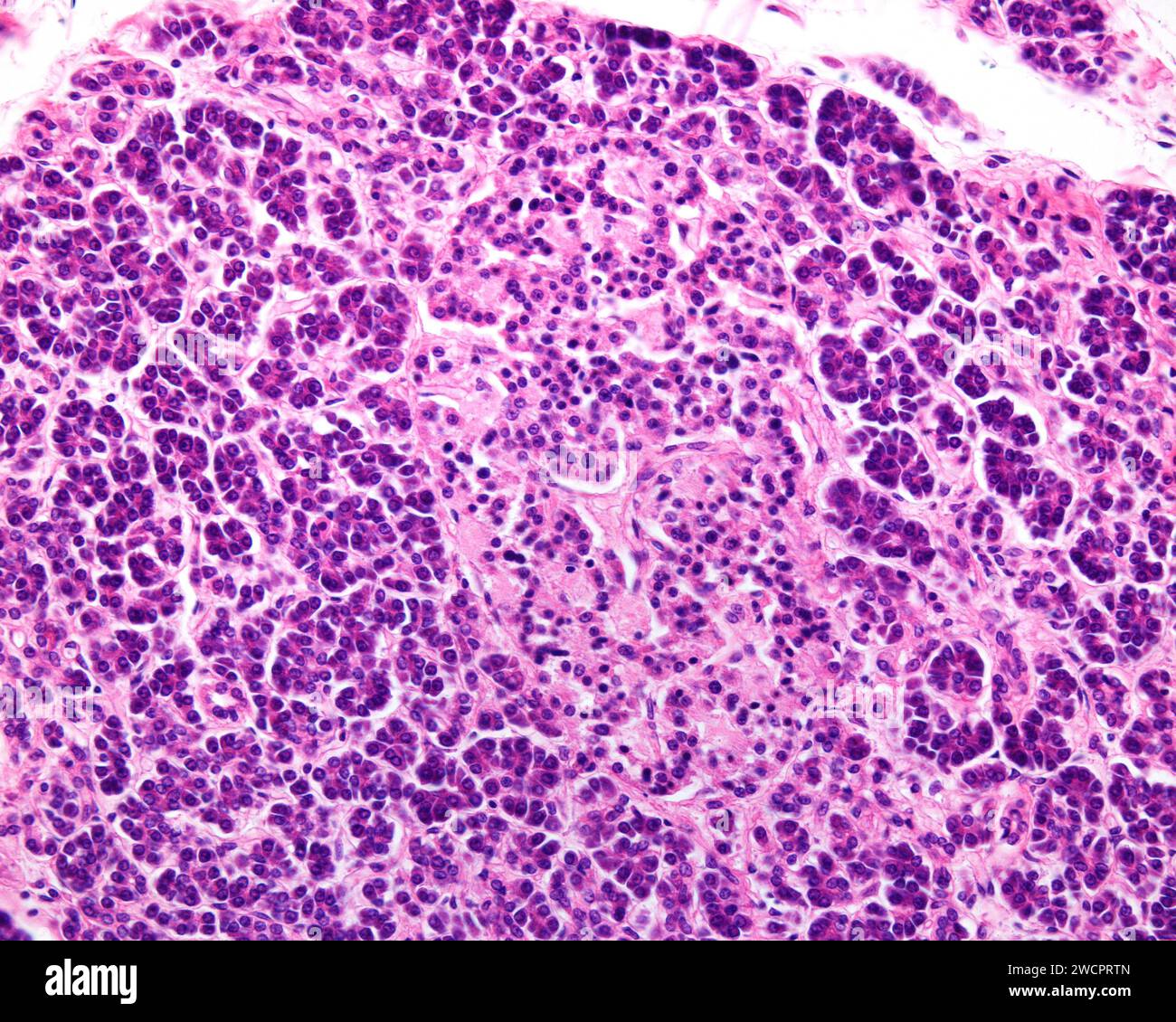 Pancreas in type 2 diabetes mellitus, light micrograph Stock Photo - Alamy