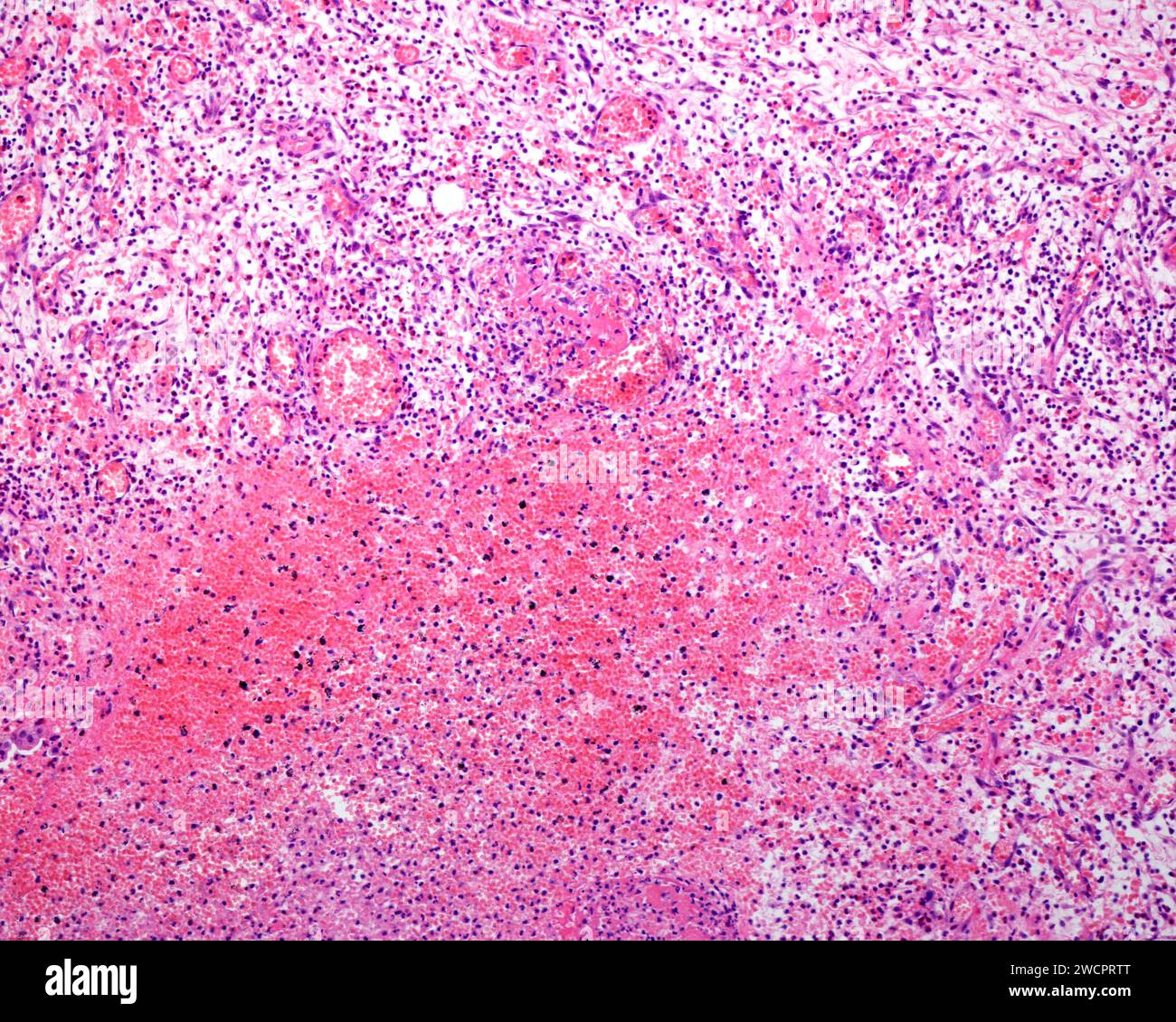 Chronic inflamed tissue, light micrograph Stock Photo - Alamy