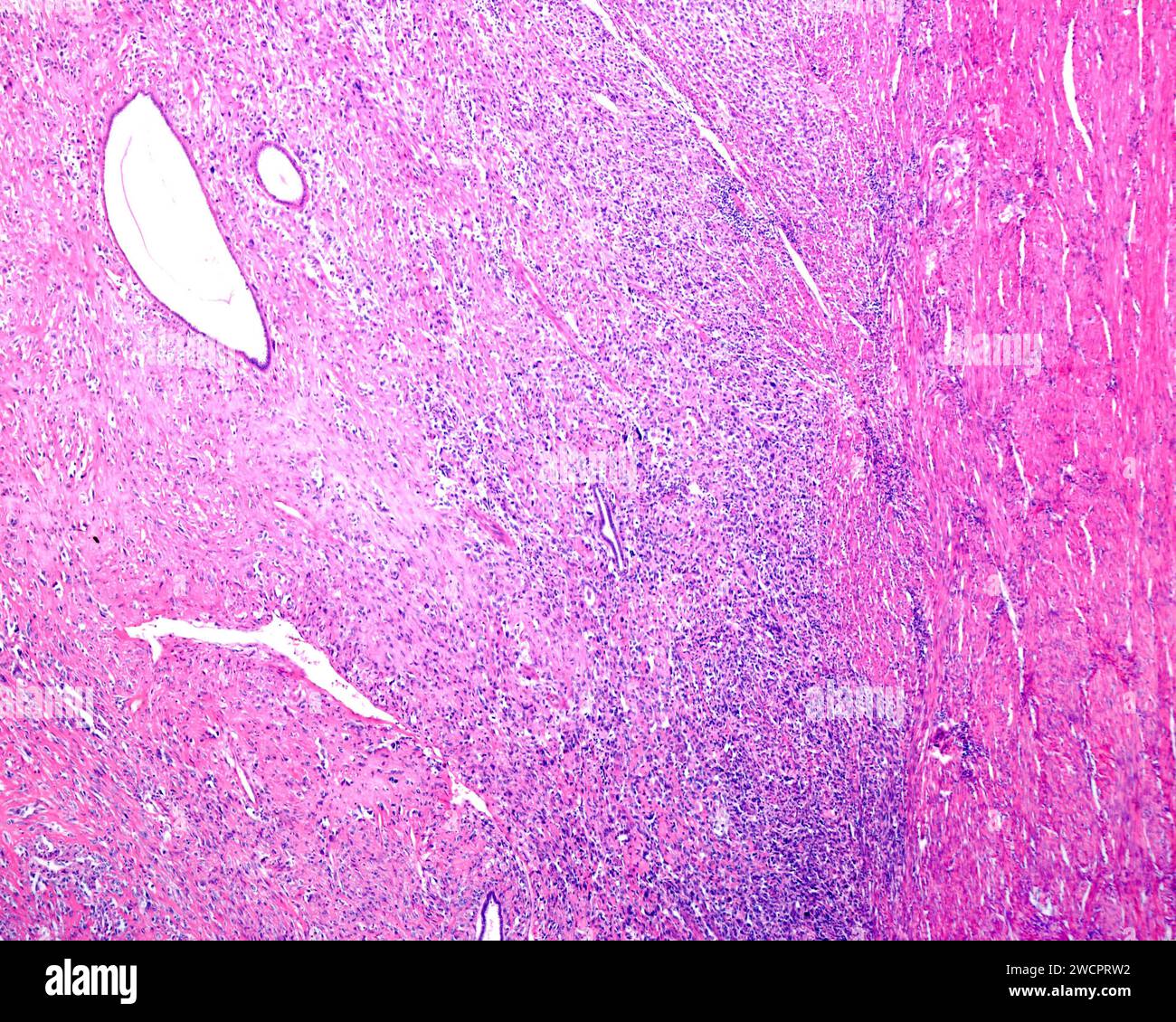 Uterine sarcoma, light micrograph Stock Photo - Alamy Uterine sarcoma, light micrograph Stock Photo - Alamy