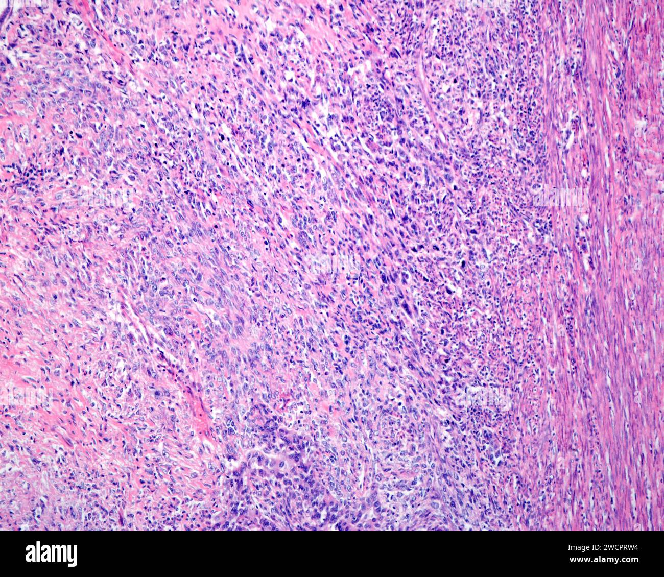 Uterine sarcoma, light micrograph Stock Photo - Alamy
