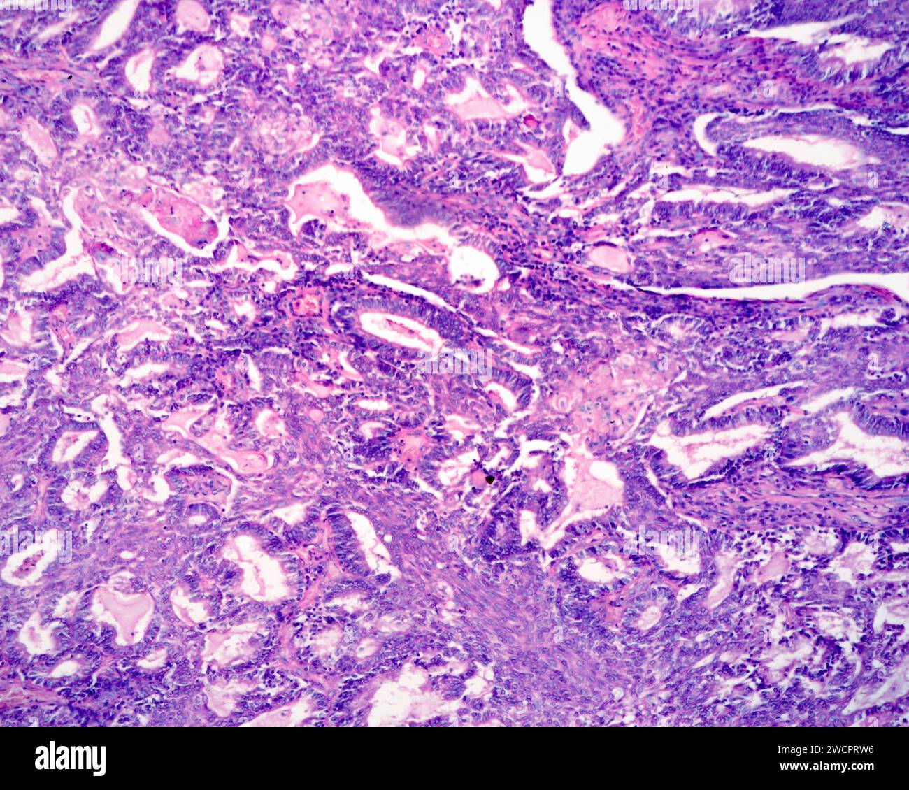 Ovarian epithelial cancer, light micrograph Stock Photo - Alamy