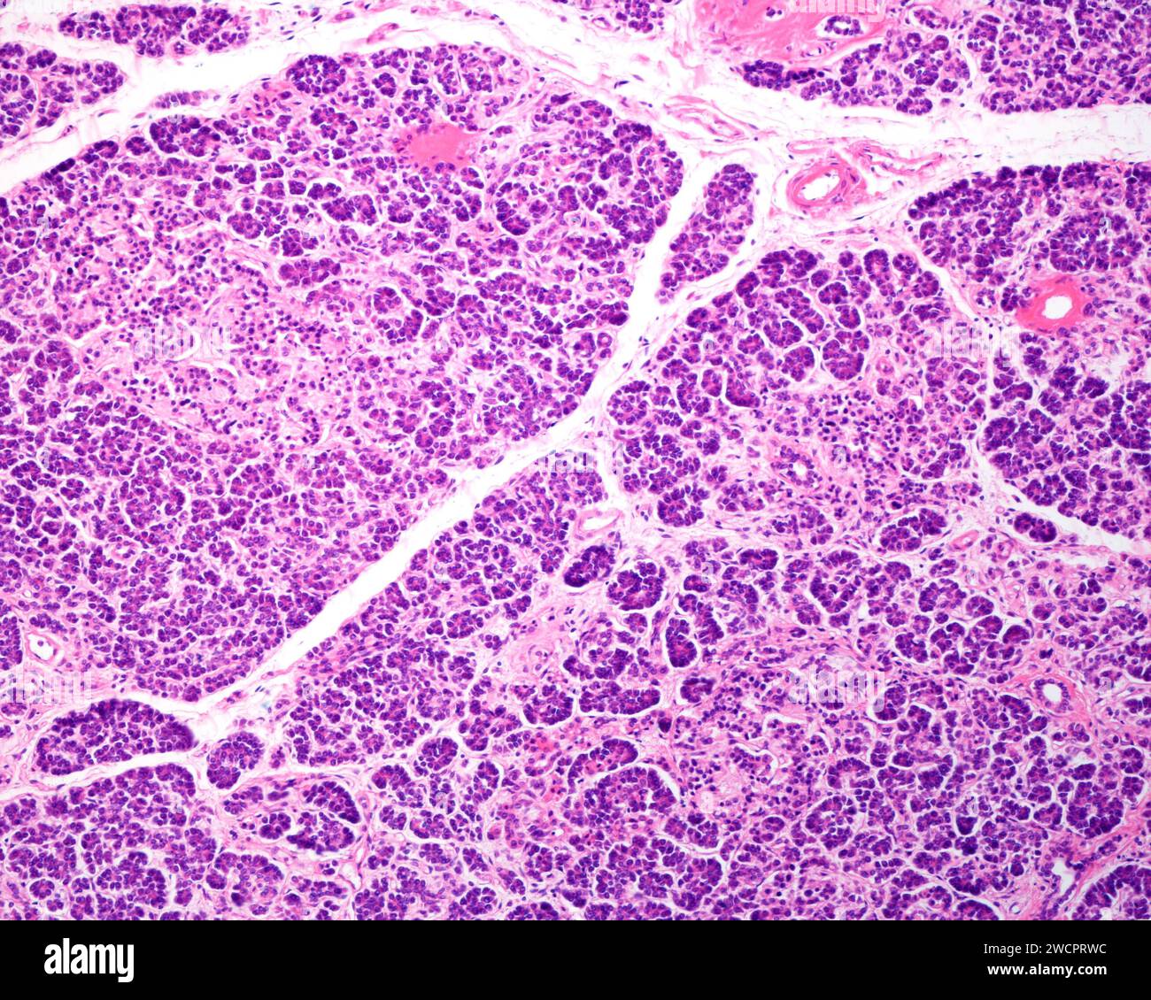 Pancreas in type 2 diabetes mellitus, light micrograph Stock Photo - Alamy
