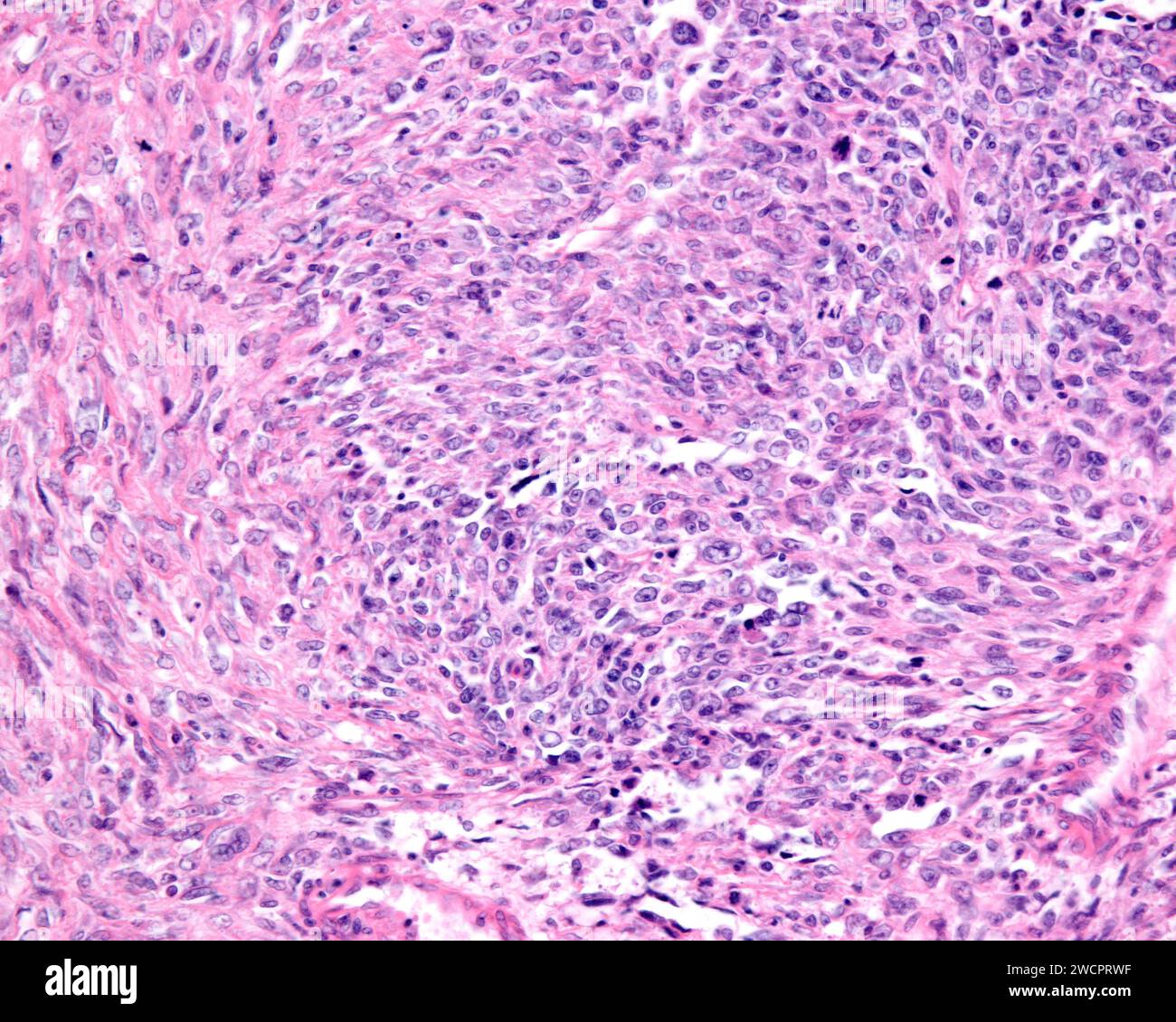 Uterine sarcoma, light micrograph Stock Photo - Alamy