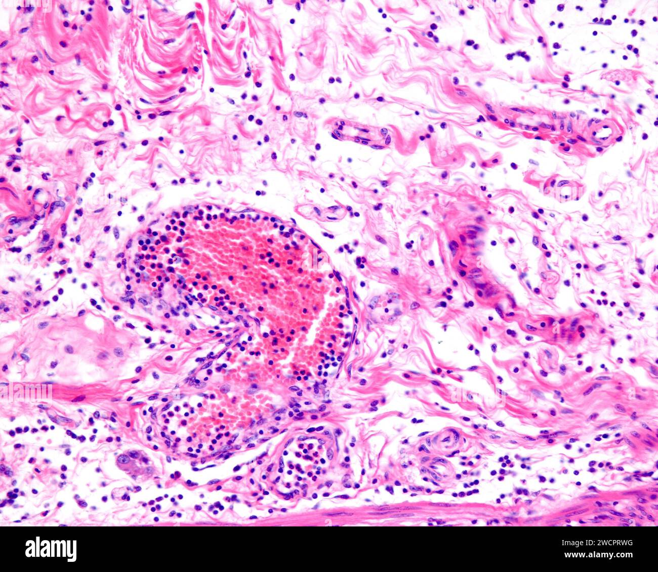 Inflammation in leukocyte diapedesis, light micrograph Stock Photo - Alamy